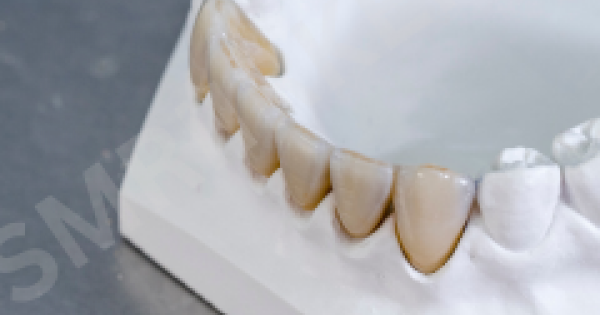 Layered Zirconia Crowns